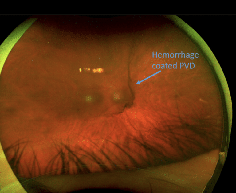 Retinal Review: April 2022