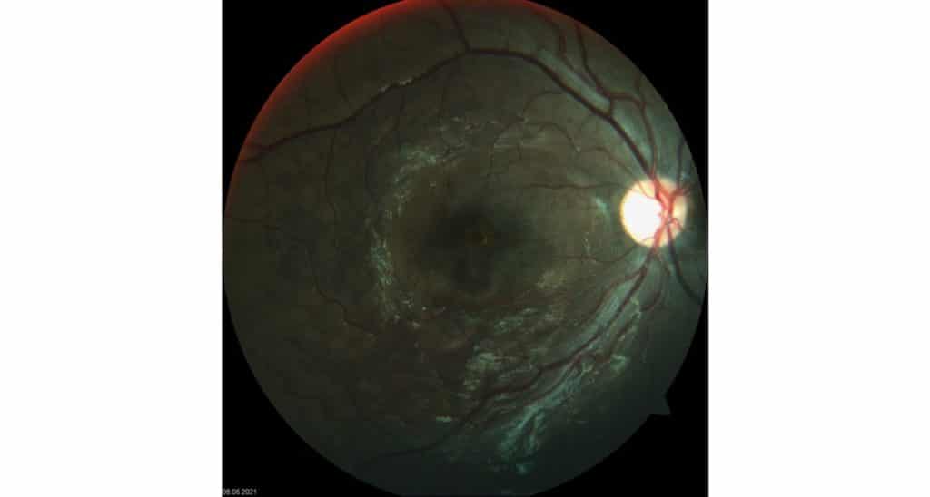 Retinal Review: August 2023 - OOMC